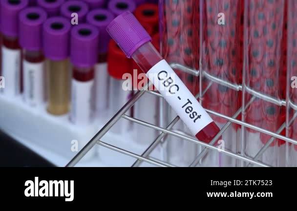 CBC test to look for abnormalities from blood, blood sample to analyze ...