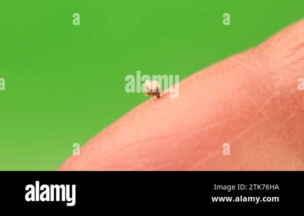 Bee's venom sac. Honey bee stings a man's finger. When the sting is ...