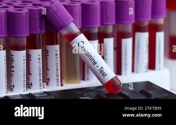 creatinine test to look for abnormalities from blood, blood sample to ...