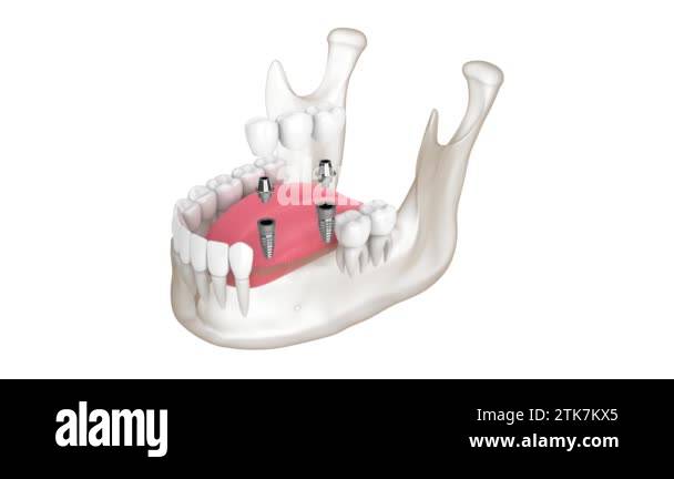 Dental bridge fixed to the mandible with two implants over white ...