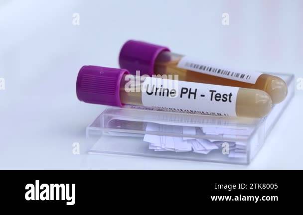Urine PH test to look for abnormalities from Urine, Urine sample to ...