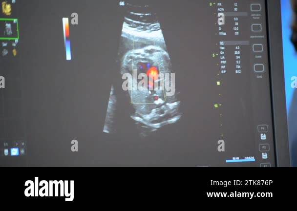 Utrasound image on the monitor close-up. Ultrasound Scan display ...
