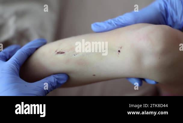 Wounds scratches abrasions on skin of child leg. Doctor examining a ...