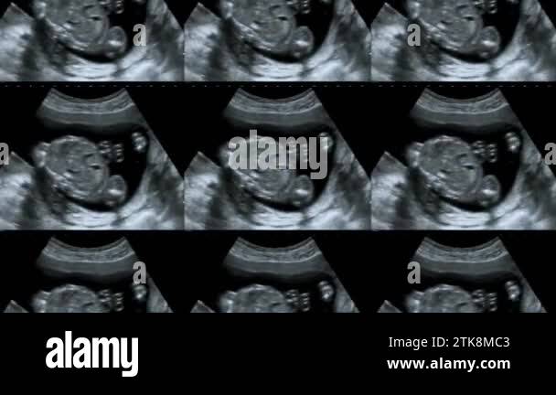 Multi screen ultrasound small baby at 12 weeks. 12 weeks pregnant ...