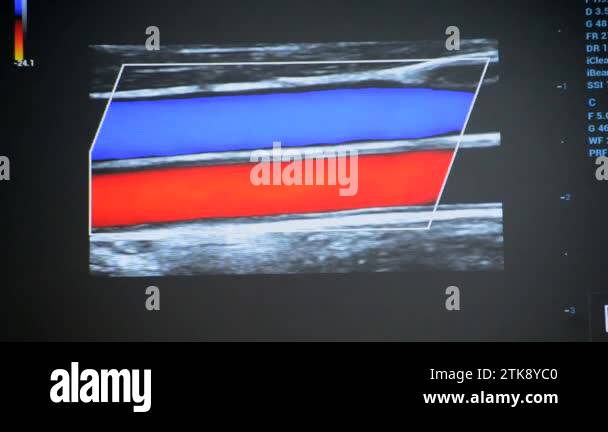 Utrasound image on the monitor close-up. Ultrasound Scan display ...