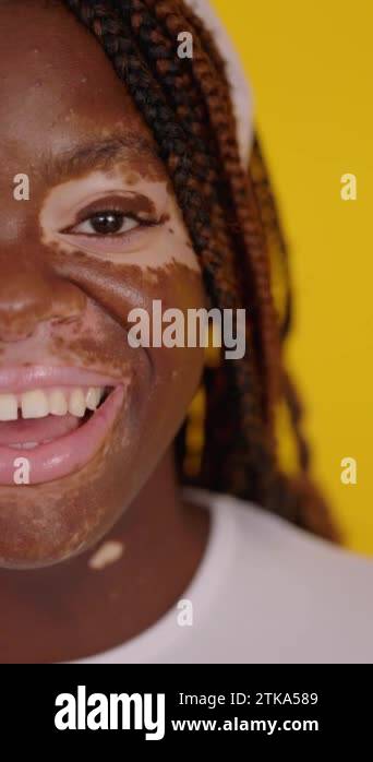 African vitiligo face Stock Videos & Footage - HD and 4K Video Clips ...