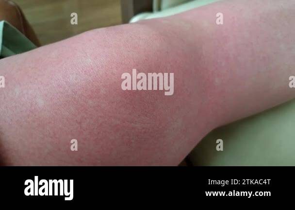 Dengue fever red spots pox rash on patient skin virus mosquito tropical ...