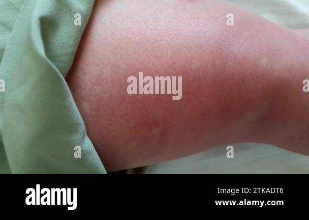 Petechiae arm Stock Videos & Footage - HD and 4K Video Clips - Alamy