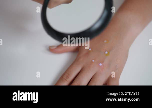 Close-up female hand with monkey pox rash and palm appearing with loupe ...