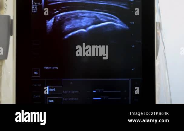 Utrasound image on the monitor close-up. Ultrasound Scan display ...