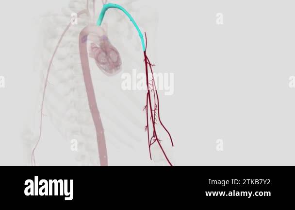 The major arteries of the upper limb are: the subclavian artery, the ...