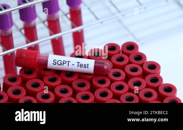 SGPT test to look for abnormalities from blood, blood sample to analyze ...