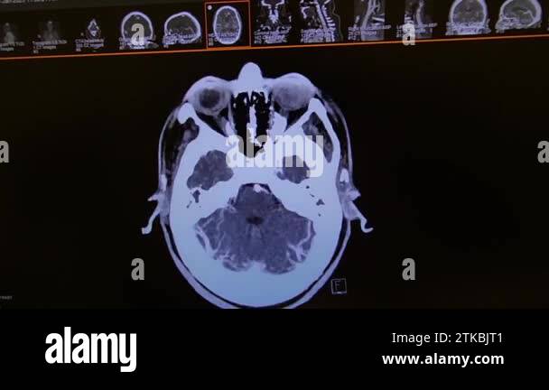 CT Brain angiography - transverse image - black, white Stock Video ...