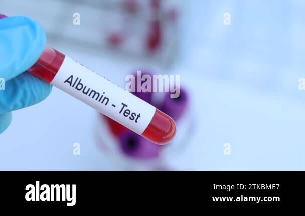 Albumin test to look for abnormalities from blood, blood sample to ...