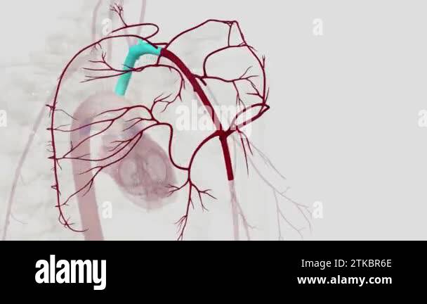 The thoracoacromial artery gives off four branches to supply the ...