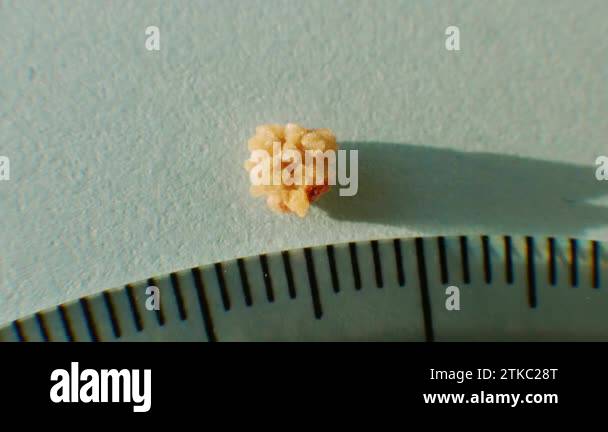 Macro shooting An oxalate stone from a human kidney close-up, measuring ...
