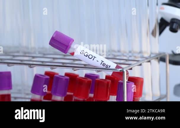 SGOT test to look for abnormalities from blood, blood sample to analyze ...