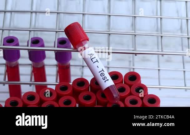 ALT test to look for abnormalities from blood, blood sample to analyze ...