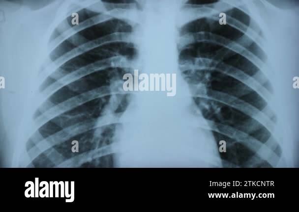 X-RAY ASSESSMENT OF THE LUNGS NORM AND PATHOLOGY. In the image of the ...
