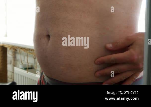 Allergic area of the skin. Allergic rash on the skin close-up. Allergy ...