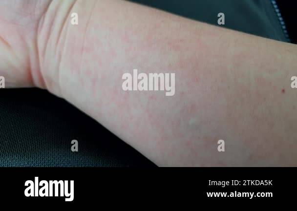 Red blood rash spots on skin dengue fever symptom mosquito tropical ...