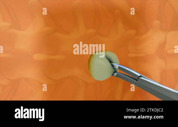 Spinal and Epidural anaesthesia Stock Video Footage - Alamy