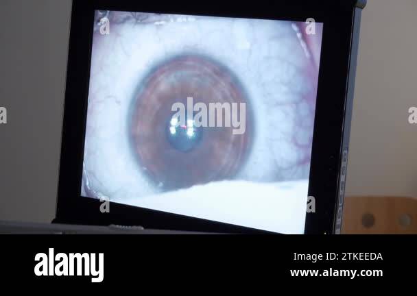 Eye surgery drawing Stock Videos & Footage - HD and 4K Video Clips - Alamy