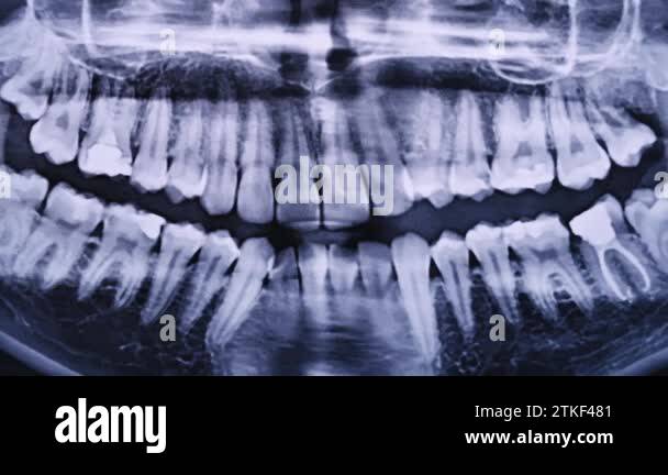 X-ray image of the jaw of all human teeth close-up. Magnetic resonance ...