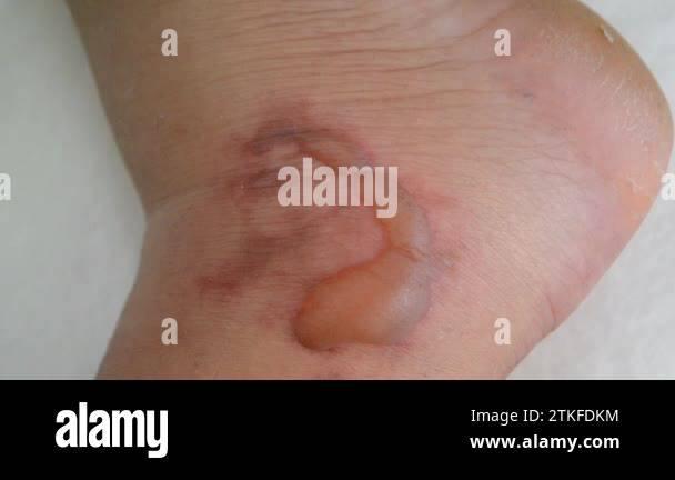 Swollen Leg With Blisters Filled With Fluid After Frostbite Close Up Swollen Foot With Fluid