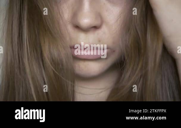 Close up of skin problems, unhealthy skin with acne and pimples. Porous ...