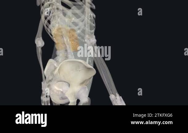 Parietal abdominal fascia (endoabdominal fascia) may be the fascia that ...