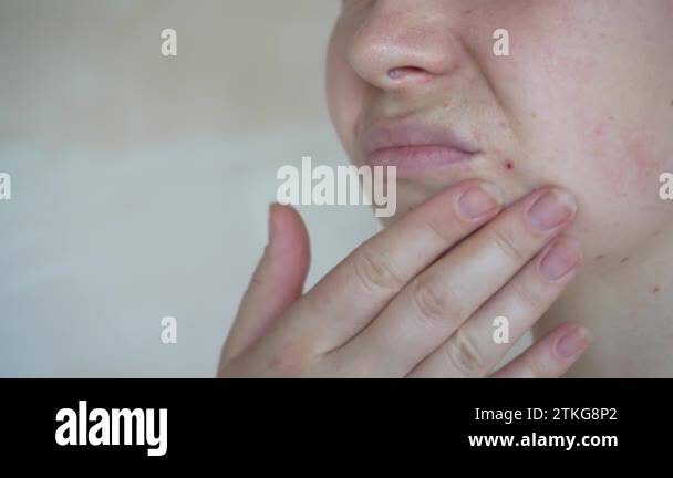 Close up of skin problems, unhealthy skin with acne and pimples. Porous ...
