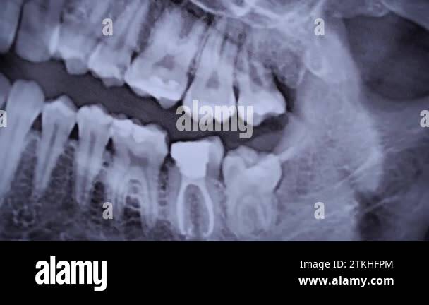 X-ray image of the jaw of all human teeth close-up. Magnetic resonance ...