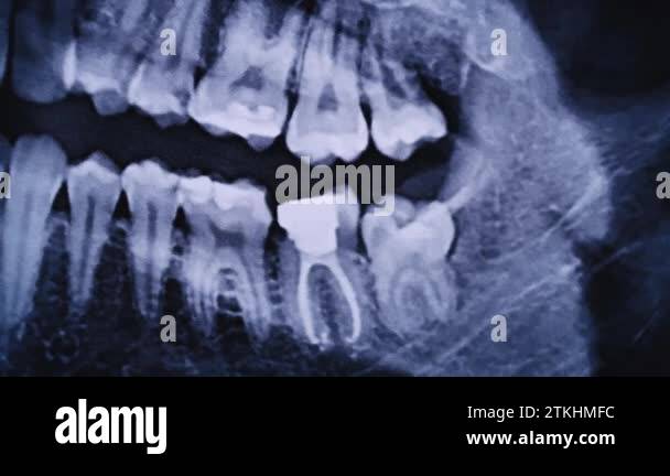 X-ray image of the jaw of all human teeth close-up. Magnetic resonance ...