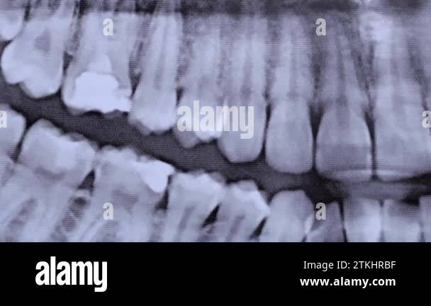 X-ray image of the jaw of all human teeth close-up. Magnetic resonance ...