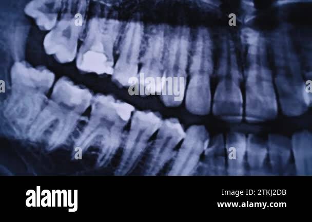 X-ray image of the jaw of all human teeth close-up. Magnetic resonance ...