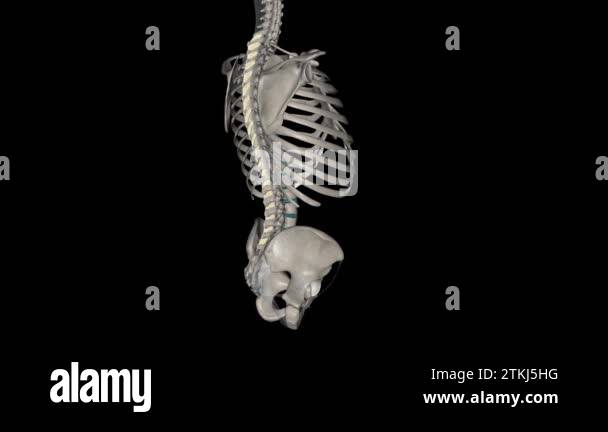 The role of the interspinous ligament is to limit flexion (bending ...