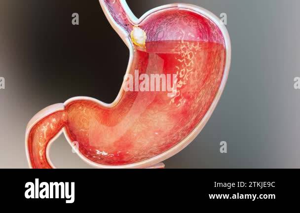 Stomach Acid Relux. Esophagus, gerd. Pain In The Digestive System ...