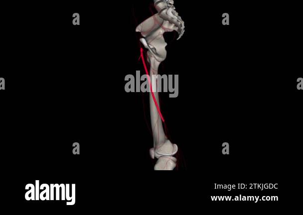 The femoral artery is a large artery in the thigh and the main arterial ...