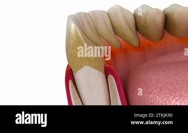 Gum periodontitis Stock Videos & Footage - HD and 4K Video Clips - Alamy