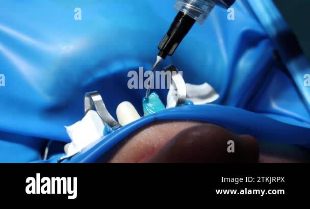 Dentist applying gel to tooth to fix veneer or crown closeup 4k movie ...