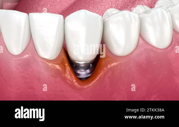 Peri implantitis Stock Videos & Footage - HD and 4K Video Clips - Alamy