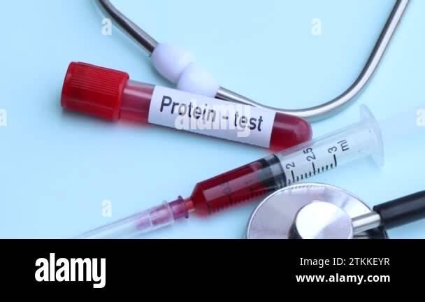protein test to look for abnormalities from blood, blood sample to ...