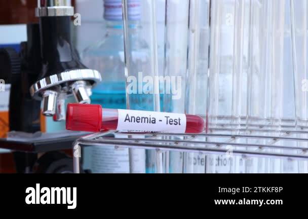 anemia test to look for abnormalities from blood, blood sample to ...