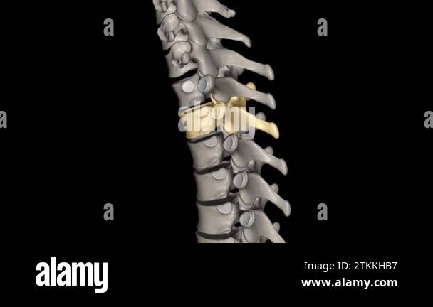 Twelve vertebrae are located in the thoracic spine and are numbered T-1 ...