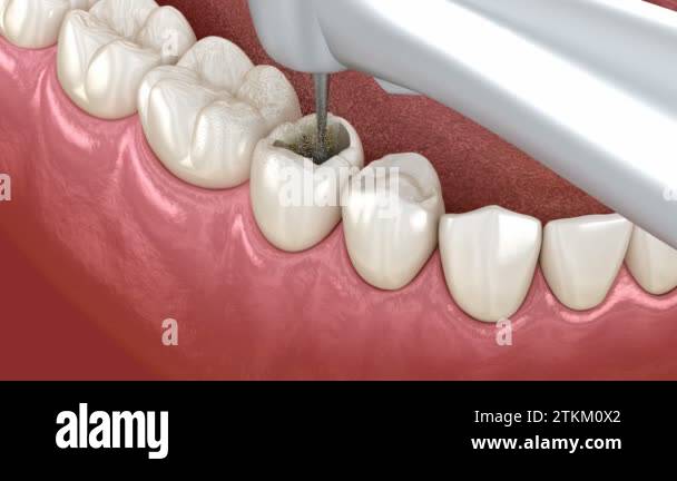 Premolar tooth restoration with composite filling. Medically accurate ...