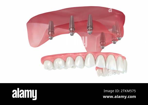 Maxillary prosthesis with gum All on 6 system supported by implants ...