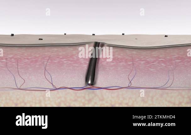 Laser hair removal 3D animation. Destruction of the hair follicles ...