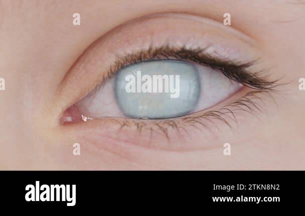 Corneal opacity of human eye. Cloudy area in the lens of eyeball in ...