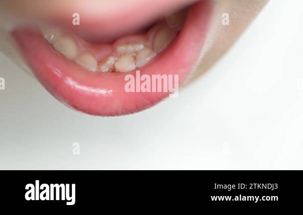 Crookedly growing teeth to replace milk teeth in a child. The second ...